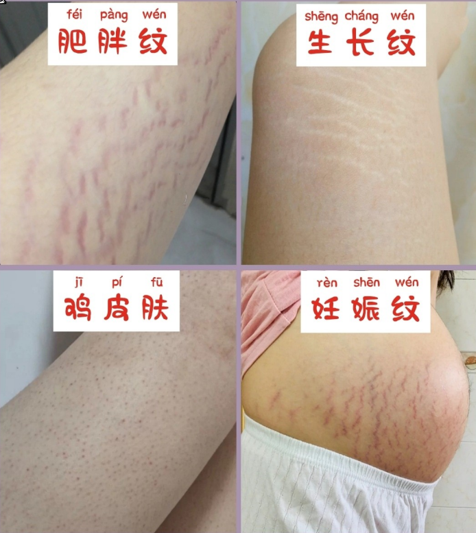 腰部生长纹生长纹肥胖纹 伤感说说吧