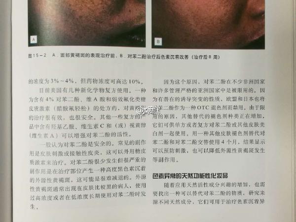 若有人推荐氢醌（对苯二酚）护肤品给你，请你谨慎 - 知乎