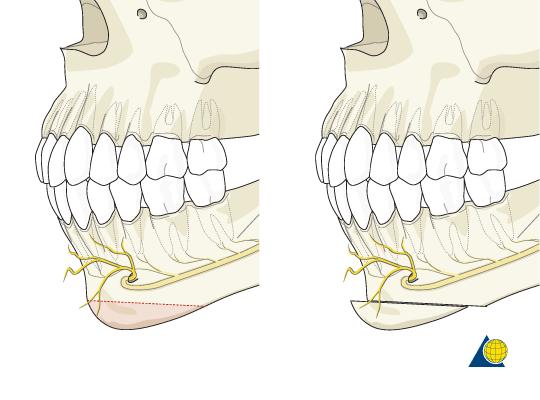 正颌外科介绍 - 知乎