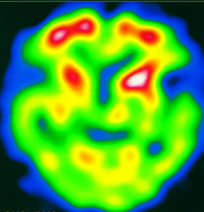 SPECT和PET和CT有什么区别，相比其他两者，SPECT有什么优势？ - 知乎