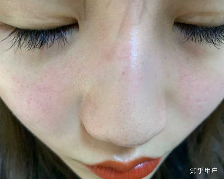 卸妆油可以去黑头吗 知乎