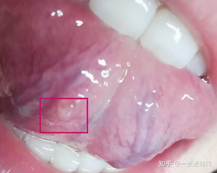 舌头下起泡是怎么回事。? 知乎