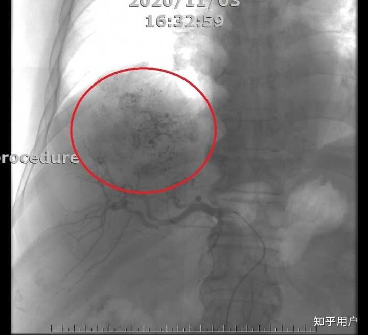 晚期肝癌的介入治疗方法怎么样？ - 知乎
