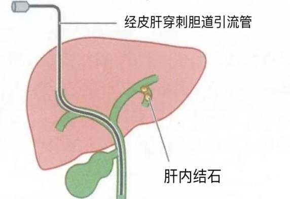 ptcd管脱落，什么情况下才能进行再次穿刺呢？ - 知乎