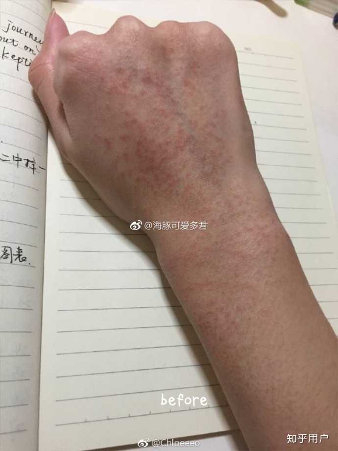 吃异维A酸（泰尔丝）可以晒太阳吗？为什么手背会出现小红疹？ - 知乎