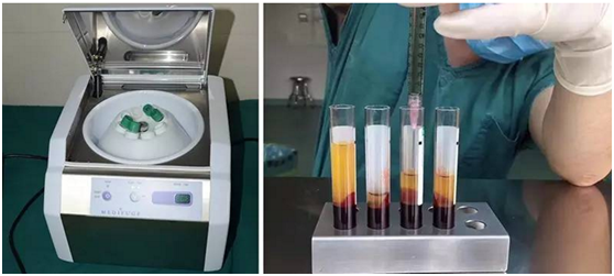 做面部脂肪填充，prp好还是cgf，之前只了解的prp。？ - 知乎