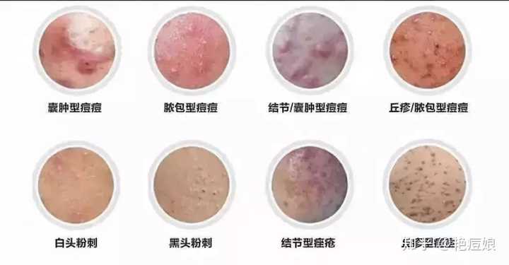 如何区分痘痘类型？ 知乎
