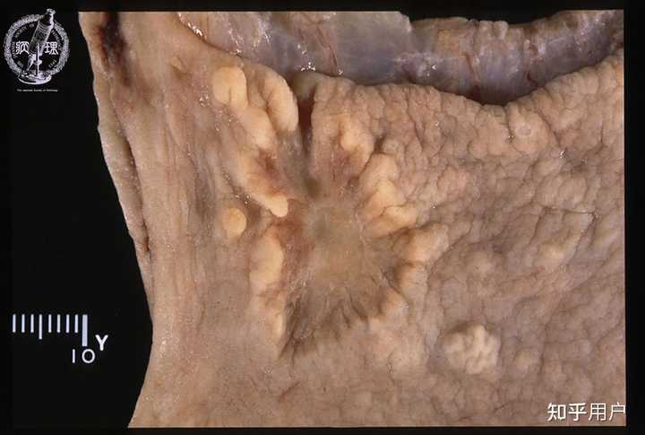 按照AJCC胃癌分期标准，这个病理报告应该怎么分期，后续化疗用药搭配有什么建议方案？ - 知乎