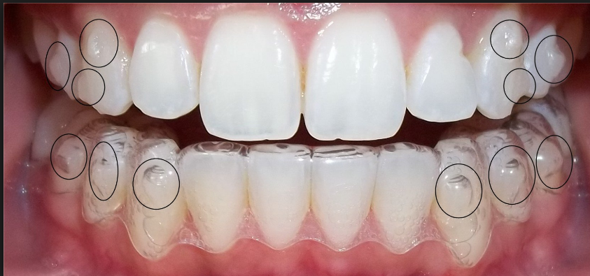 在英国戴隐形矫正牙套Invisalign的经历 - 知乎