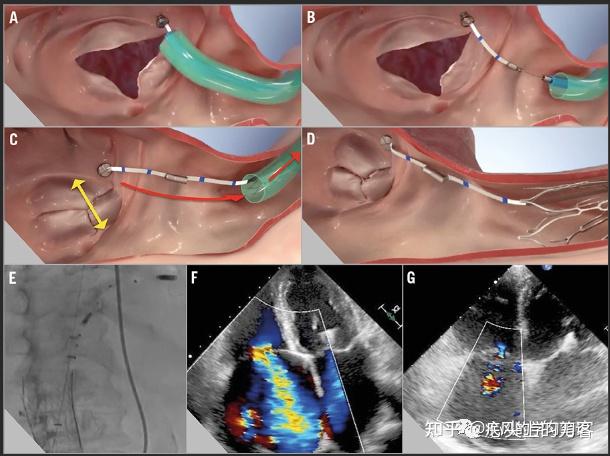 三尖瓣关闭不全综合征及治疗 - 知乎