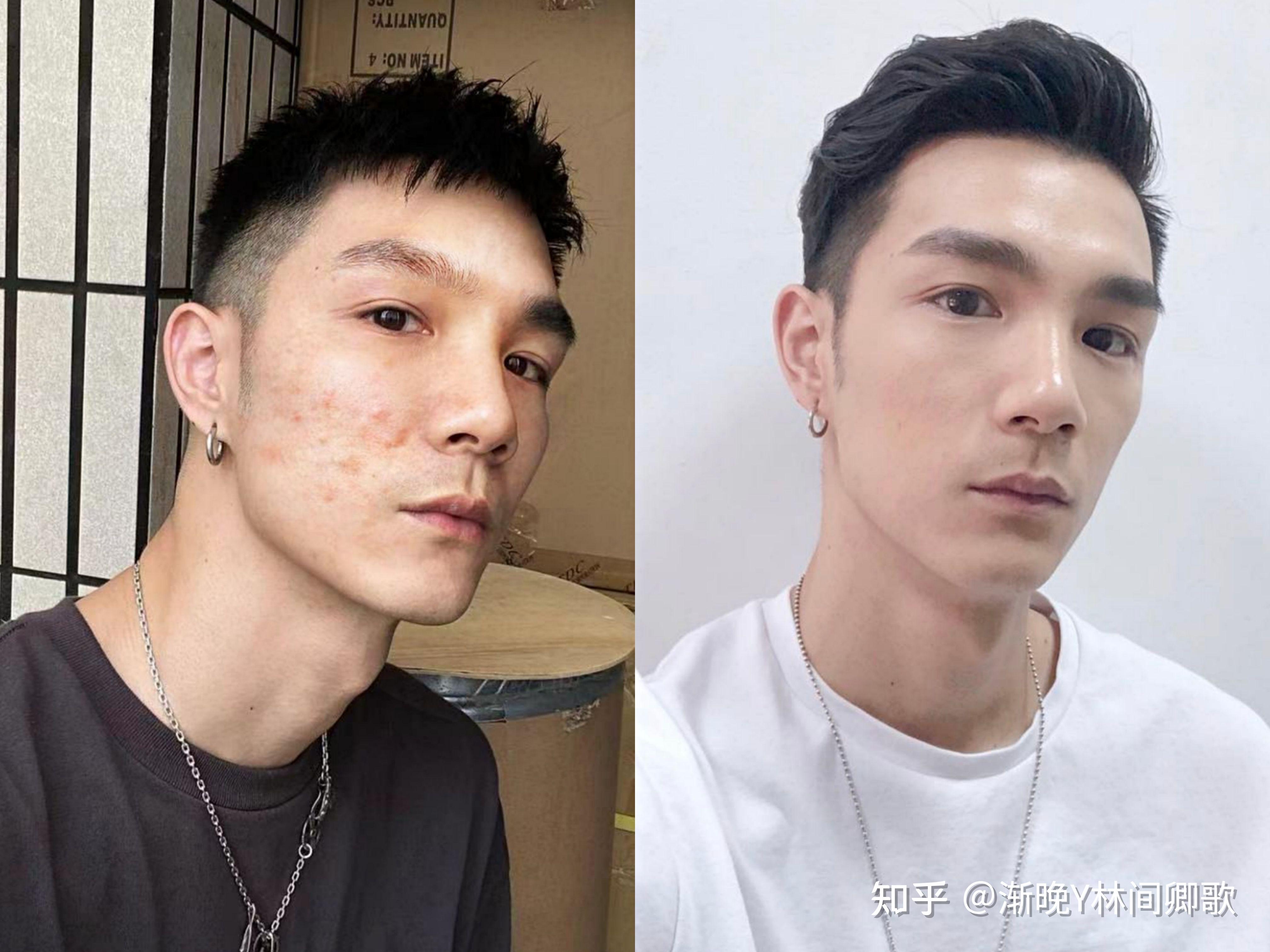 你们试过最有效最快速的祛痘和祛痘印方法是什么? 知乎