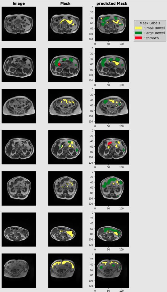 UW-Madison GI Tract Image Segmentation 肠胃部磁共振分割数据集介绍 - 知乎