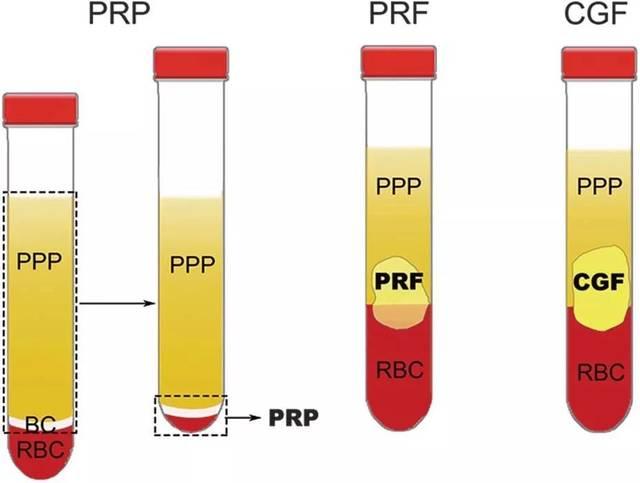 临床上所用的PRP、PRF和CGF都是血液制品，它们的区别在哪里？ - 知乎