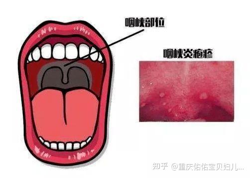 疱疹性咽峡炎真的这么“可怕”?会二次感染吗?如何预防呢? 知乎