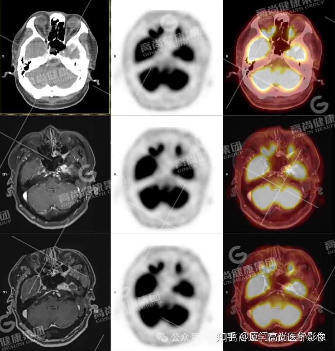 【高尚病例】PET/CT-MR 多模态融合技术在临床中的应用病例分享（一） - 知乎