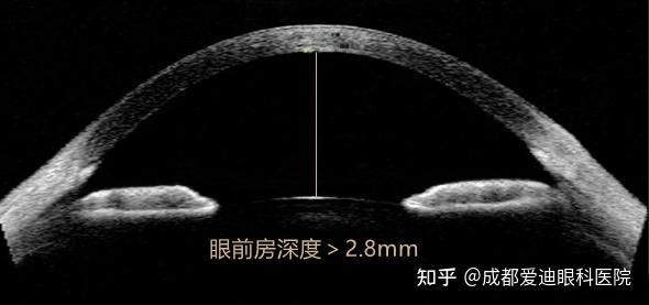 近视手术攻略-ICL晶体植入术篇 - 知乎