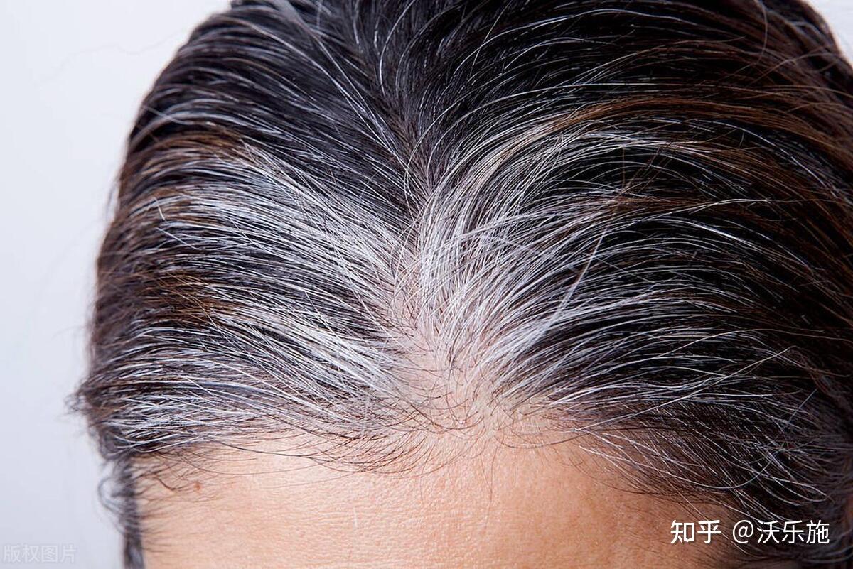 白发变多7原因，吃什么改善白发？ - 知乎
