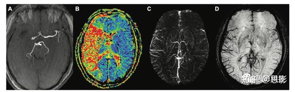 磁敏感加权成像（SWI)：技术要点和临床神经学应用 - 知乎
