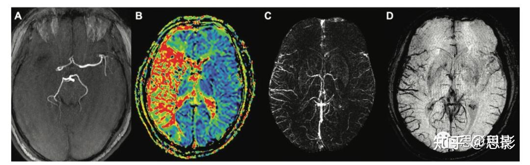 磁敏感加权成像（SWI)：技术要点和临床神经学应用 - 知乎