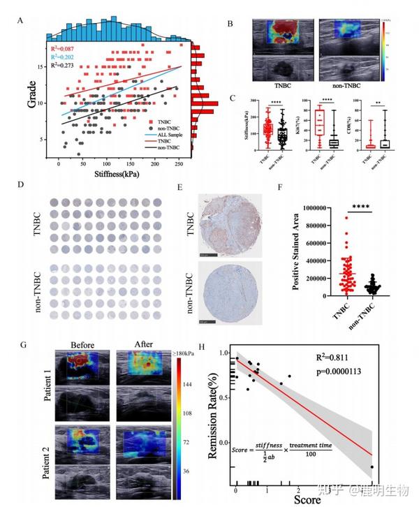 单细胞测序助力探究三阴乳腺肿瘤硬度及抗肿瘤药物药效的影响 - 知乎