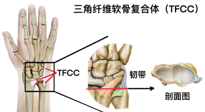 健身引起的三角纤维软骨复合体TFCC损伤预防和康复 - 知乎