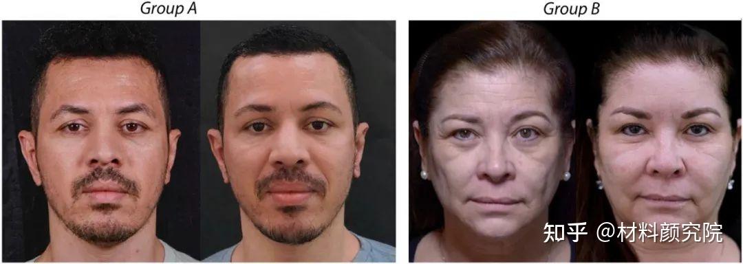 刚柔并济 | 羟基磷灰石CaHA+HA，组队“双打”再生抗衰更香~ - 知乎