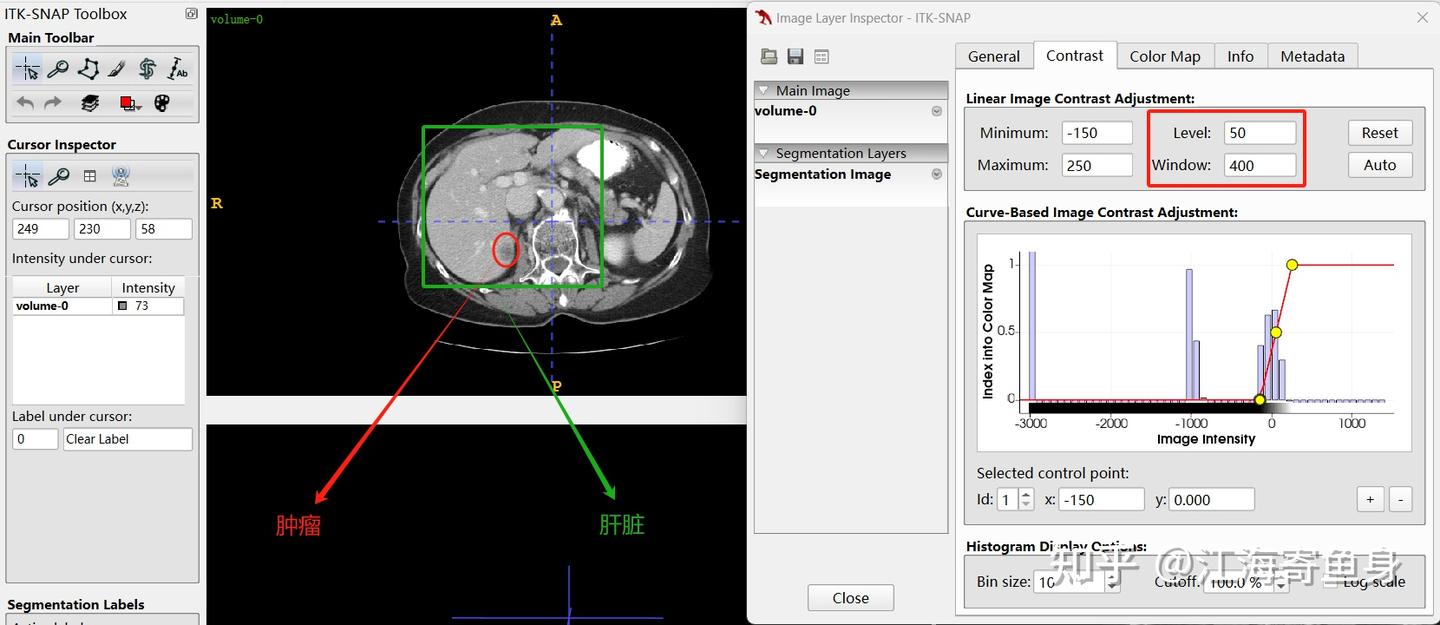 [项目实战]基于UNet的肝脏肿瘤多类分割（一）ITK-SNAP调窗 - 知乎