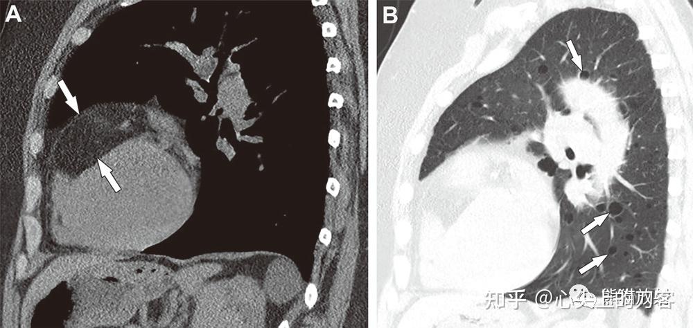 结节性硬化症丨诊断标准、影像表现、临床监测与治疗 - 知乎
