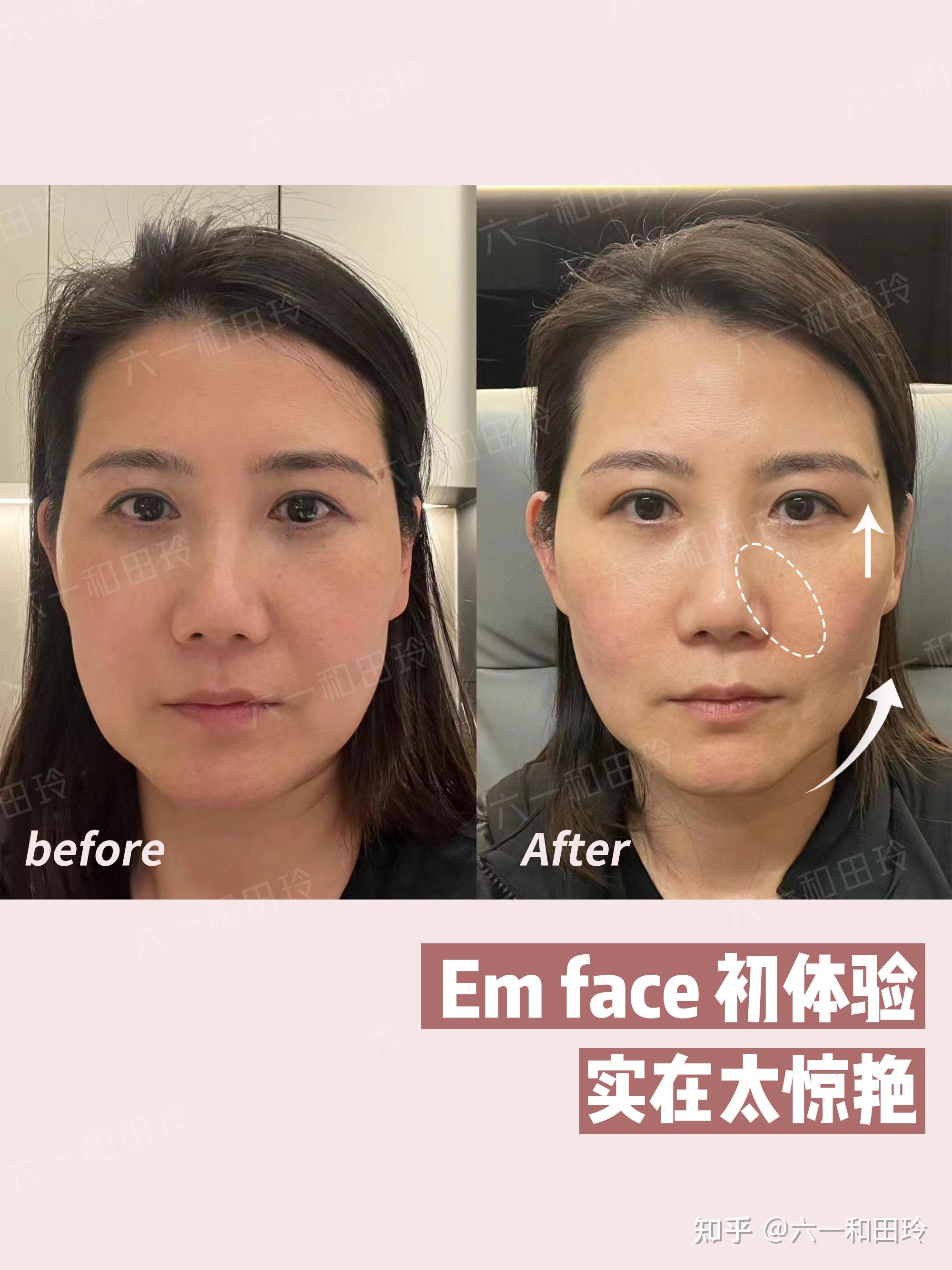 来repo一下我的EM Face初体验，真的好惊艳。 - 知乎