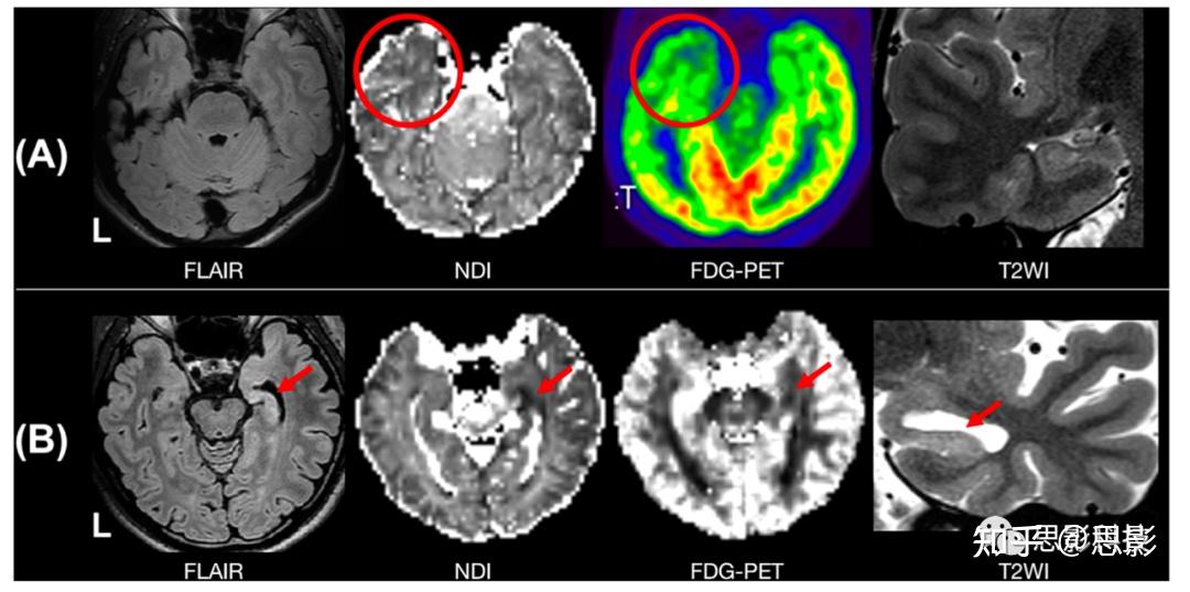 NODDI在临床研究中的应用 - 知乎