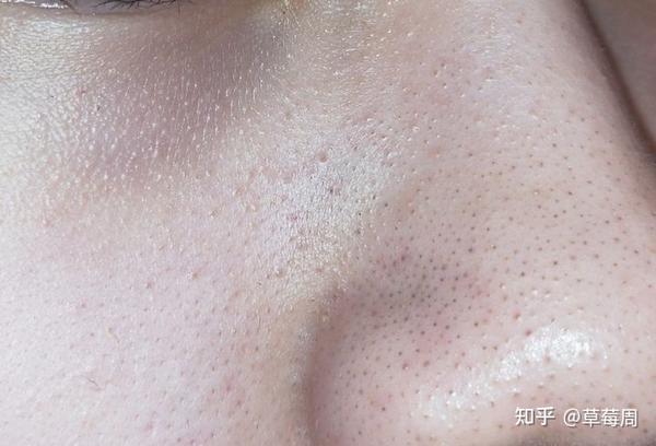 有什么好用的去黑头产品推荐吗?想知道大家都是怎么去黑头的? 知乎