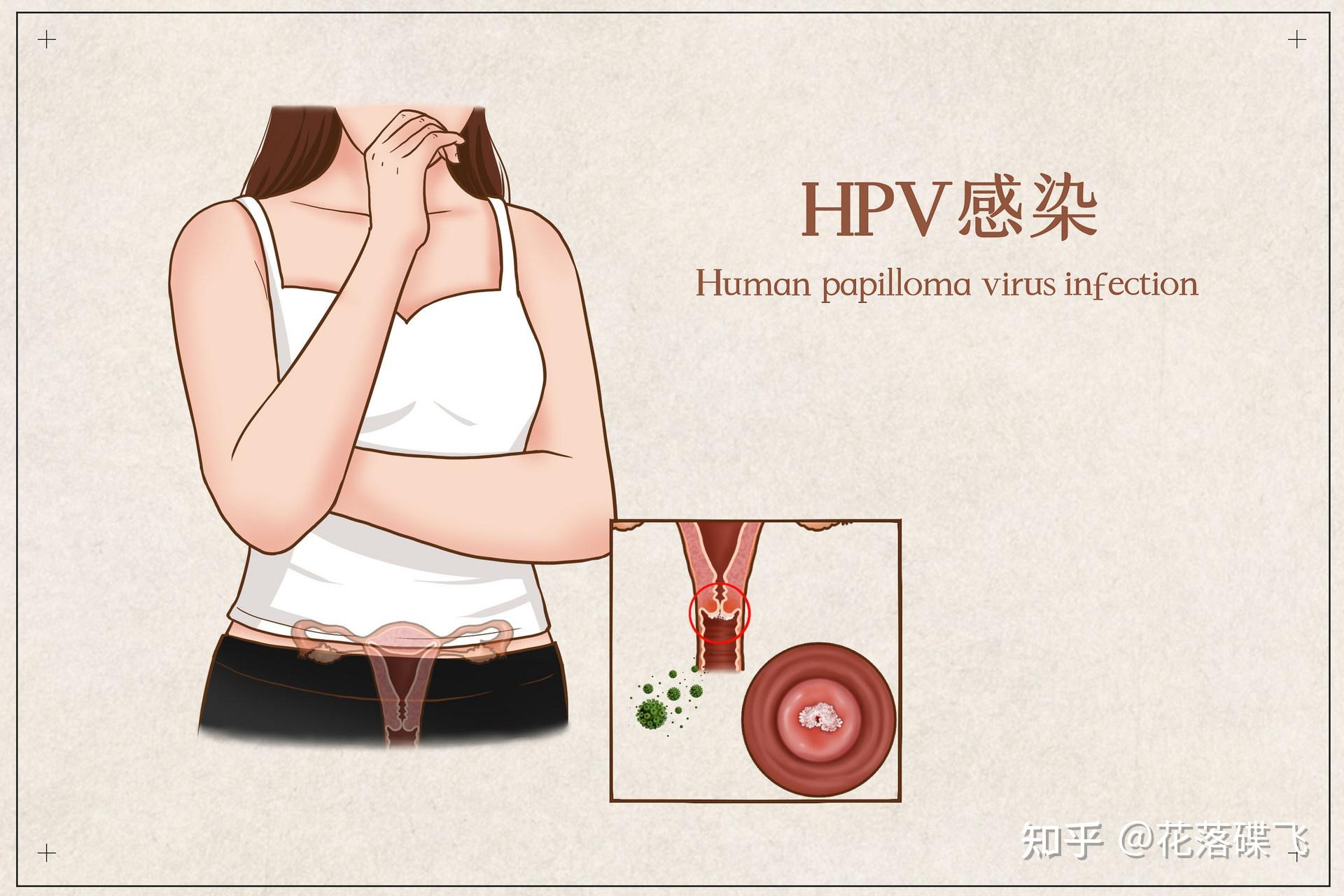 HPV科普小课堂，你确定不了解一番？ - 知乎