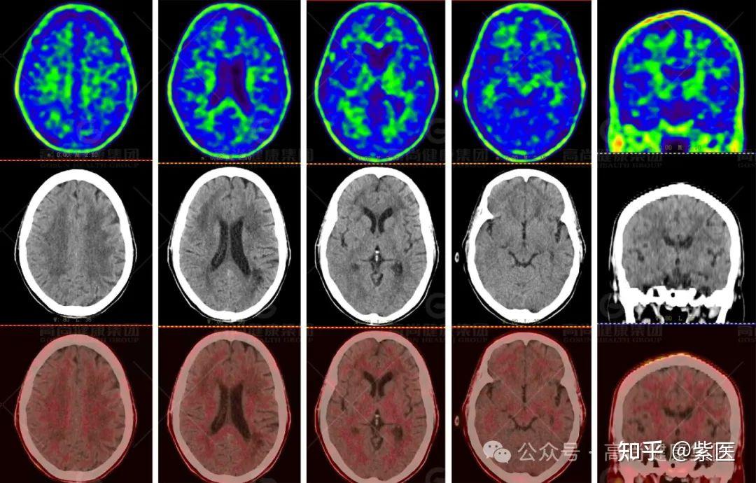 学术荟萃系列专题 | PET脑成像在阿尔茨海默病的应用价值 - 知乎