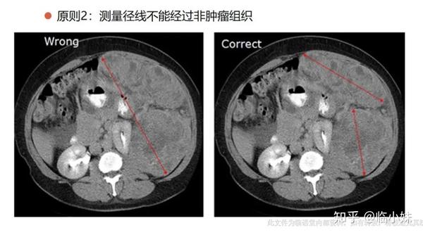 收藏 | 肿瘤临床试验（下）RECIST评估 - 知乎