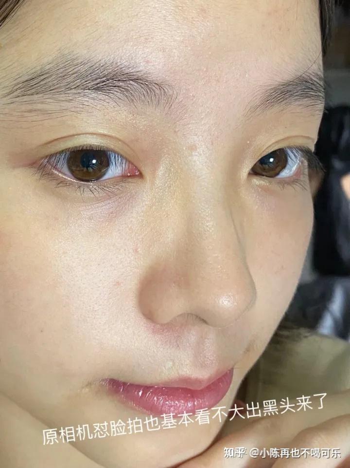 女孩子脸上黑头密密麻麻的该怎么办？有什么简单的去黑头方法？ 知乎