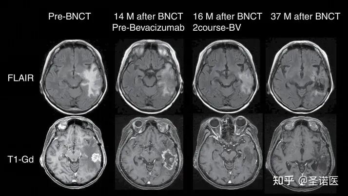 2025年9月22日欧盟批准Vorasidenib(沃拉西地尼、Voranigo)用于治疗IDH1/2突变的2级胶质瘤 - 知乎