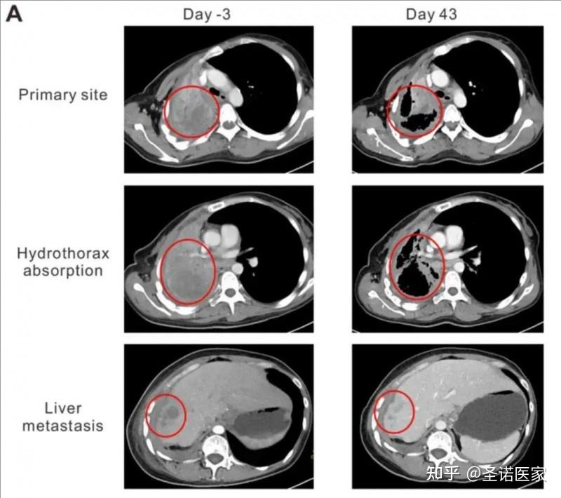 2025年欧洲肝病年会SCG101数据亮眼,TCRT细胞疗法让肝癌、肺癌、肠癌等迎破晓时刻 - 知乎