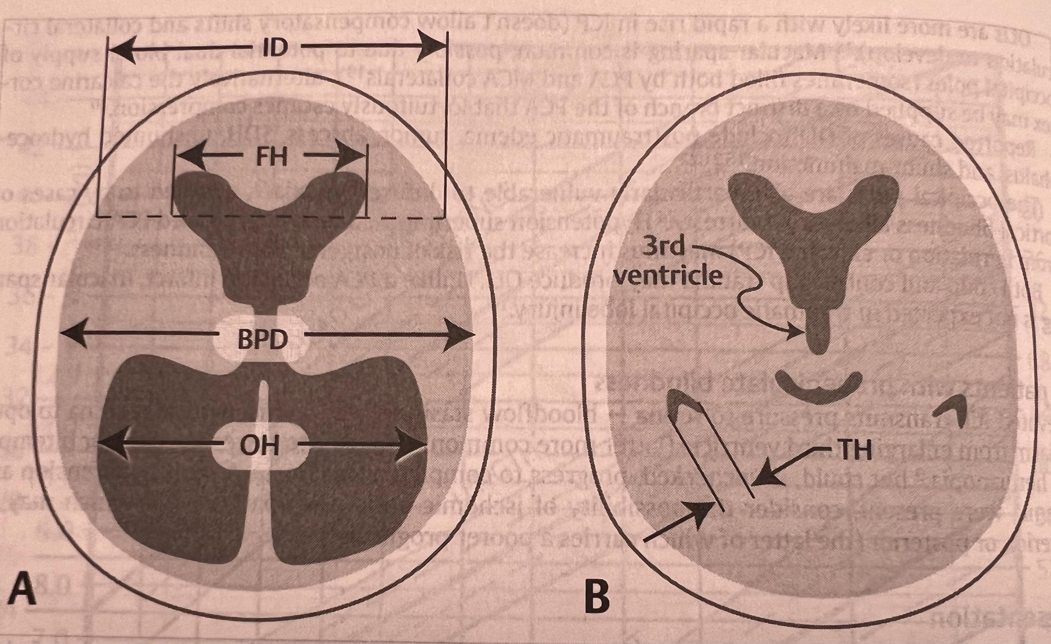 脑积水的影像测量方法——Evans ratio - 知乎