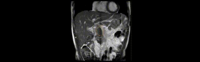 MRIdian Linac 磁共振引导放疗系统介绍 - 知乎