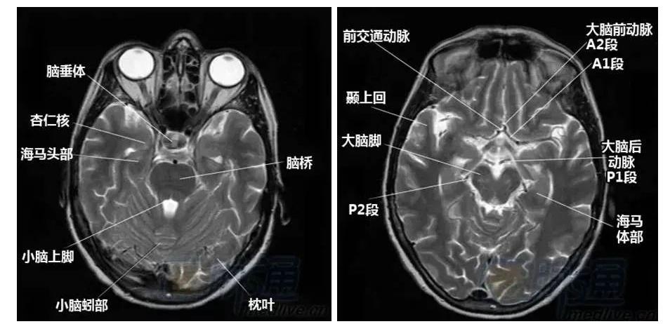 神内临床笔记56 正常颅脑MRI表现 - 知乎