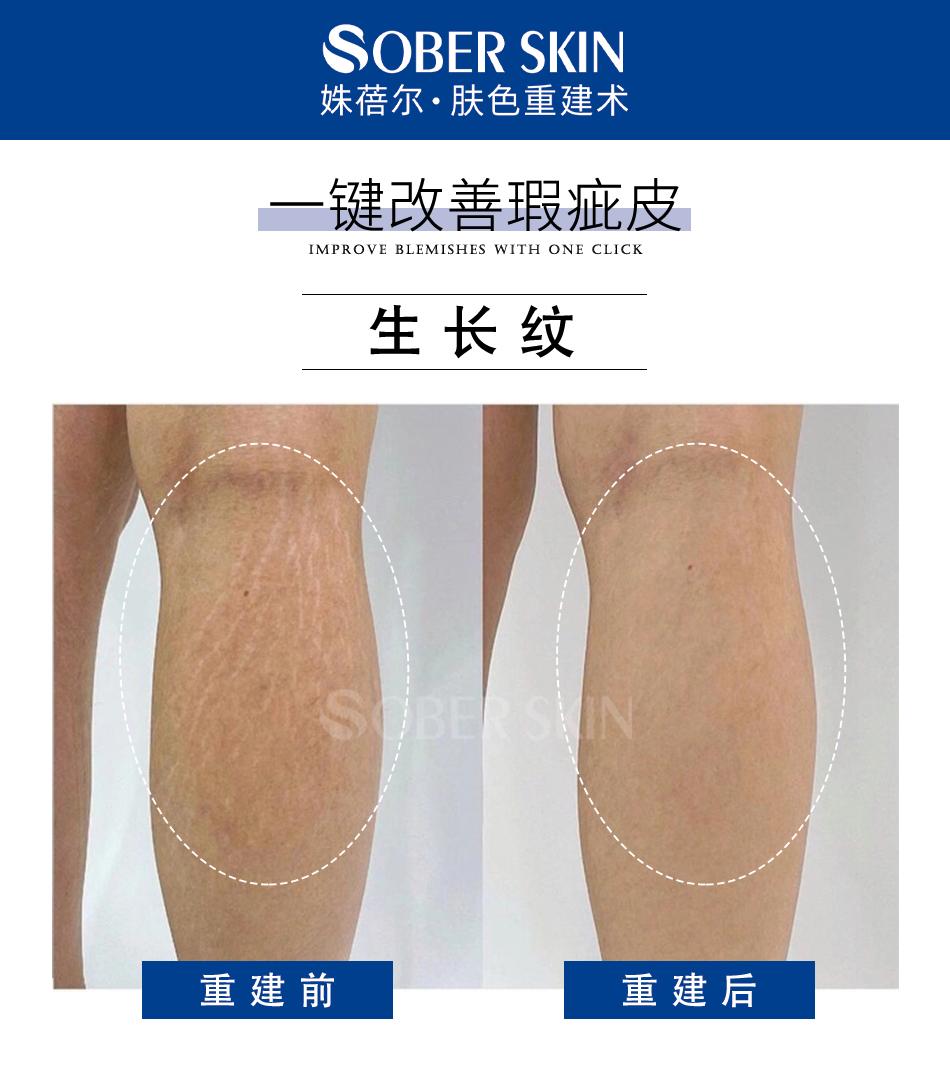 如何祛掉腿上的生长纹和肥胖纹 知乎