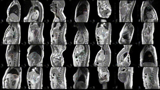 MRIdian Linac 磁共振引导放疗系统介绍 - 知乎