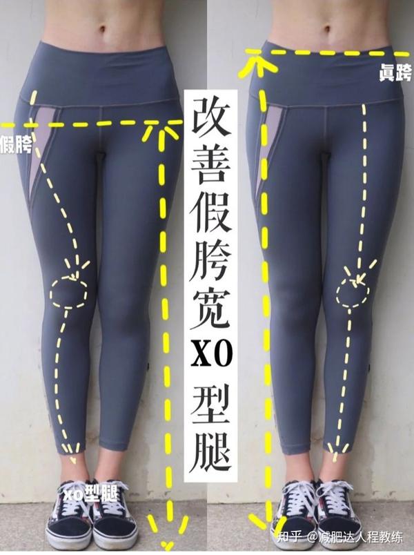 XO型腿怎么分辨？ - 知乎