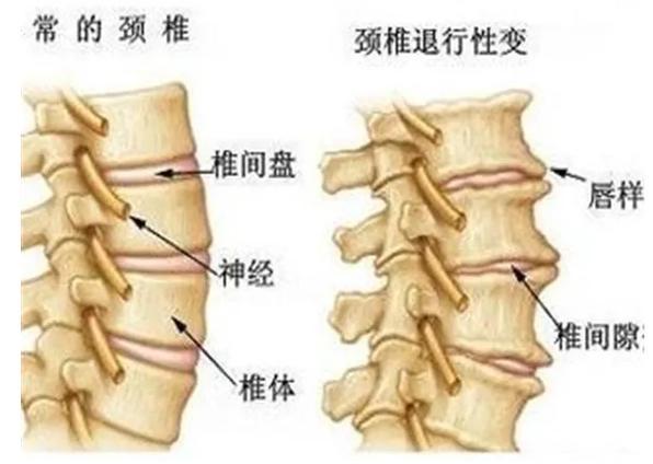 颈肩综合症——颈肩退行性改变 知乎