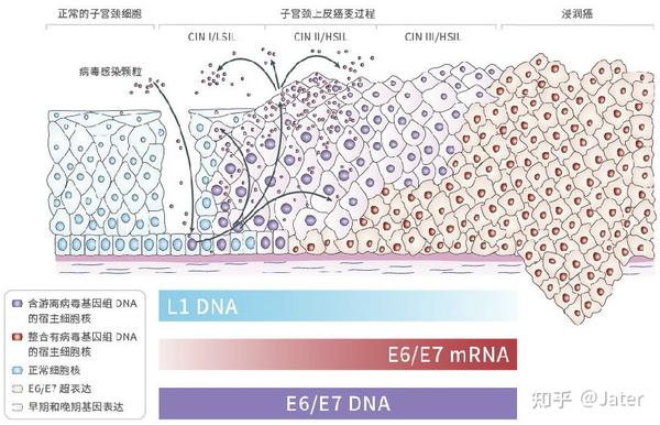 为什么要检测HPV E6/E7 mRNA呢？ - 知乎