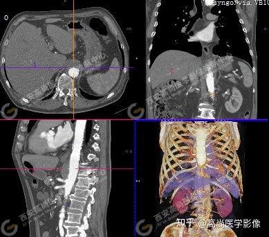 PET/CT-CTA多模态诊断穿透性动脉粥样硬化性溃疡（PAU）一例 - 知乎