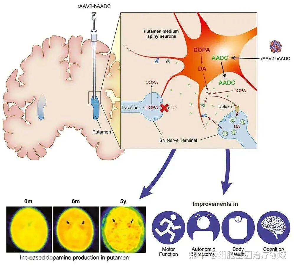 AAV基因疗法Upstaza™在英国获批上市 - 知乎