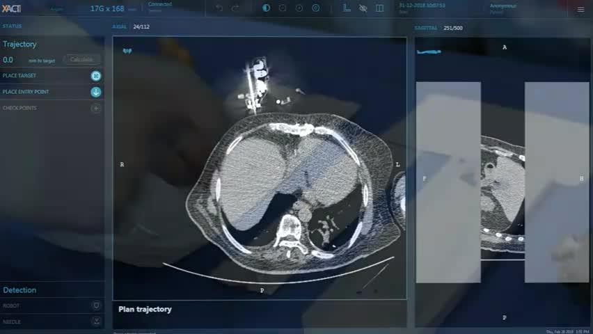 无人操作手术机器人XACT Robotics完成第1例远程控制介入性肿瘤经皮手术 - 知乎