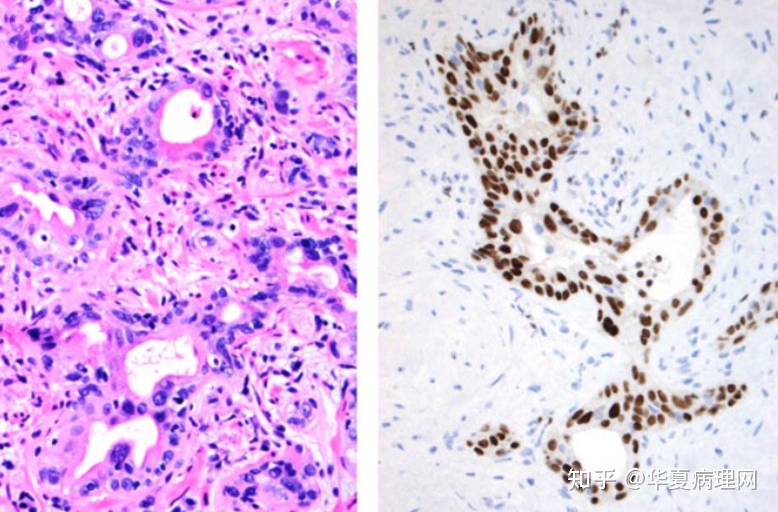 分子时代学病理-GATA3基因 - 知乎