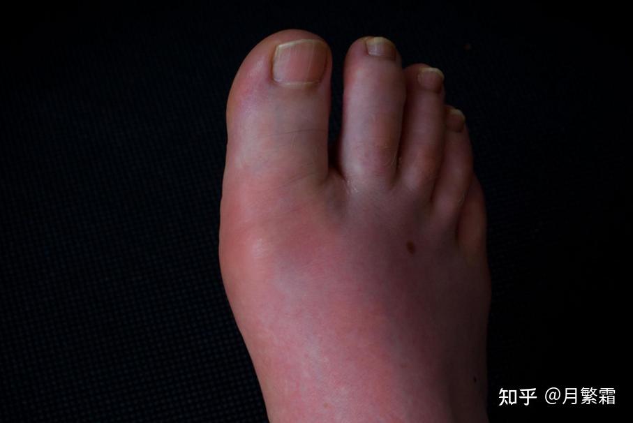 尿酸高有哪些症状 知乎